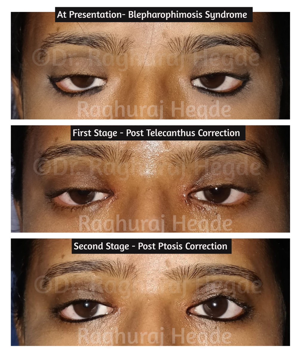 Opening the eyes! Blepharophimosis – DR. RAGHURAJ HEGDE