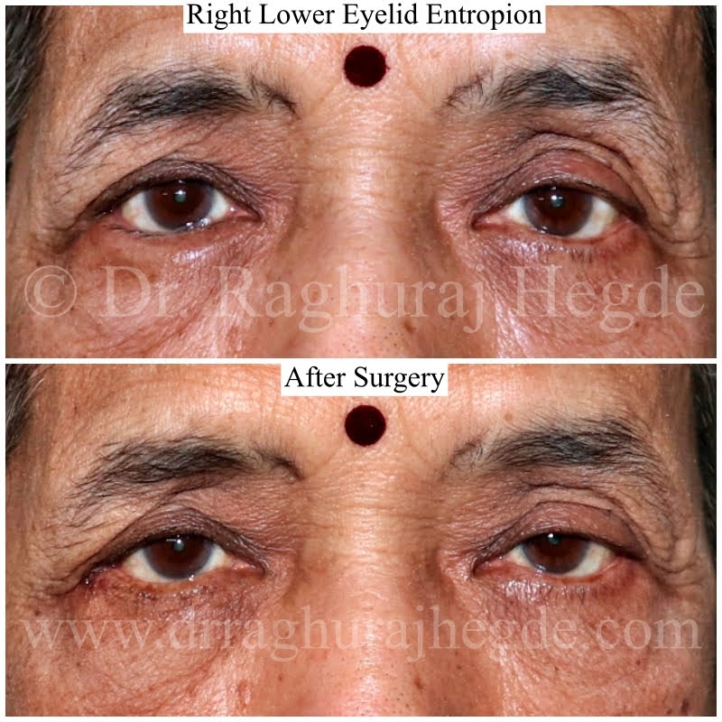 Riding up the Lower lid! – DR. RAGHURAJ HEGDE