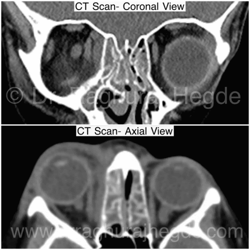 Dangers Lurking Around the Eye – DR. RAGHURAJ HEGDE